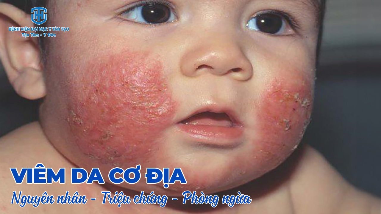 Viêm da cơ địa: Nguyên nhân, triệu chứng và cách phòng ngừa - Bệnh viện ...